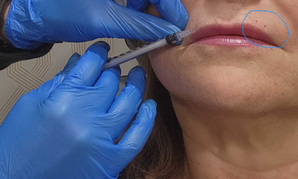Botox Lip Flip How Many Units For A Perfect Pout