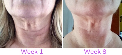 My Neck Firming Results No Expensive Procedures