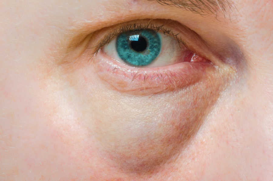 Swelling After Tear Trough Filler: How Long Will it Last? What To Do?